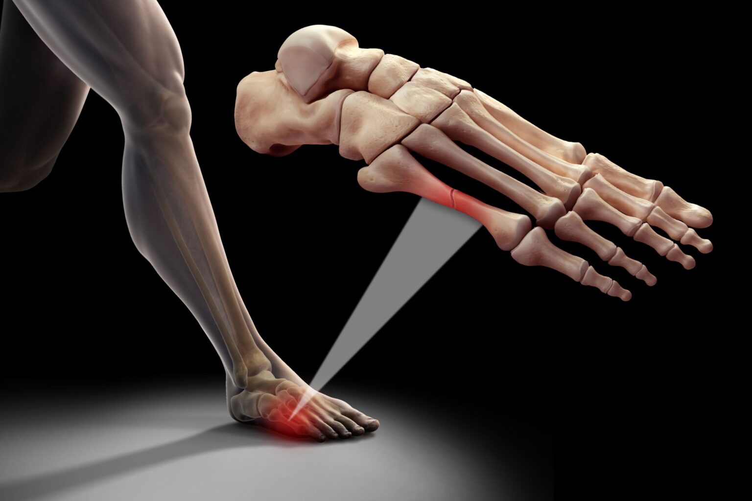 FRACTURES – Paramount Podiatry